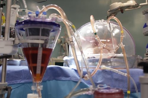 Creating universal blood-type organs for transplant - Hospital News